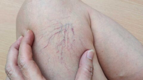 PEIM: Como Funciona o Tratamento Para Vasinhos nas Pernas?