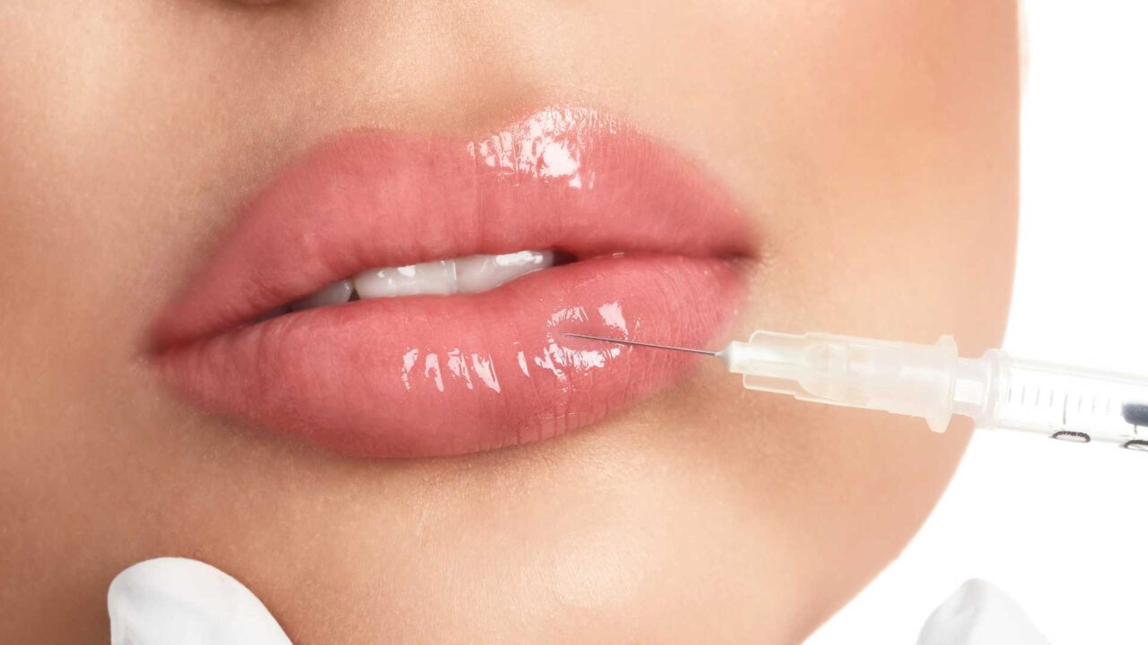 Quais São as Fases do Preenchimento Labial?